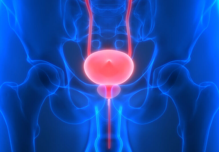 Bladder Neck Contracture (BNC) | Female and Reconstructive Urologist ...